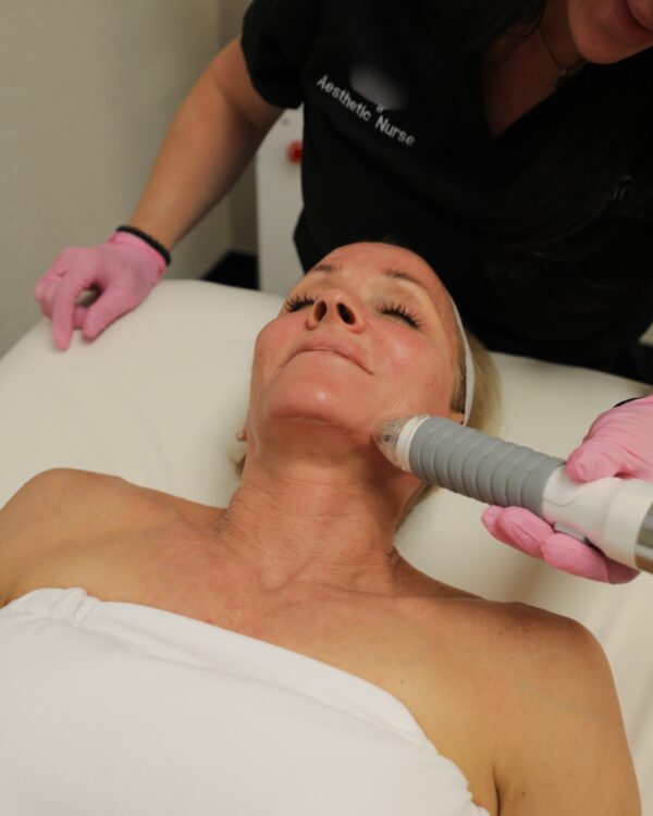 Vivace RF Microneedling | Radiance Medspa Belleair Bluffs